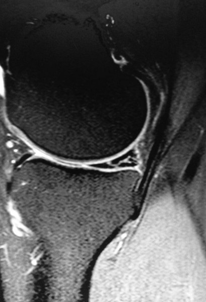 Lésion méniscale - Dr Aparicio